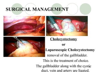 Lect 28 Cholecystitis-Cholelithiasis.ppt
