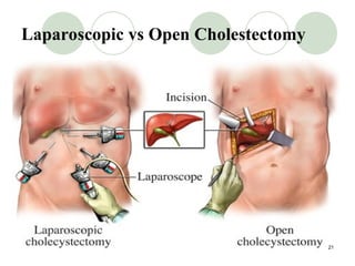 Lect 28 Cholecystitis-Cholelithiasis.ppt