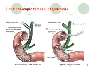 Lect 28 Cholecystitis-Cholelithiasis.ppt