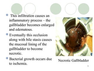 Lect 28 Cholecystitis-Cholelithiasis.ppt