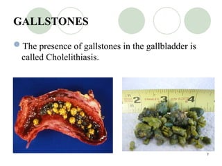 Lect 28 Cholecystitis-Cholelithiasis.ppt