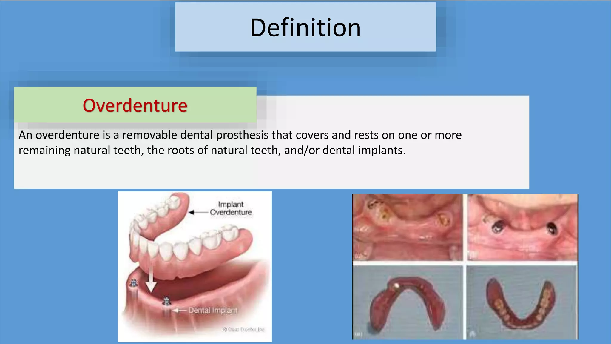 lect2 overdenture level 3.pptx