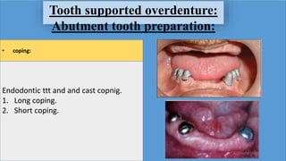 lect2 overdenture level 3.pptx