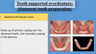 lect2 overdenture level 3.pptx