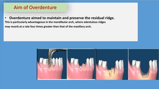 lect2 overdenture level 3.pptx