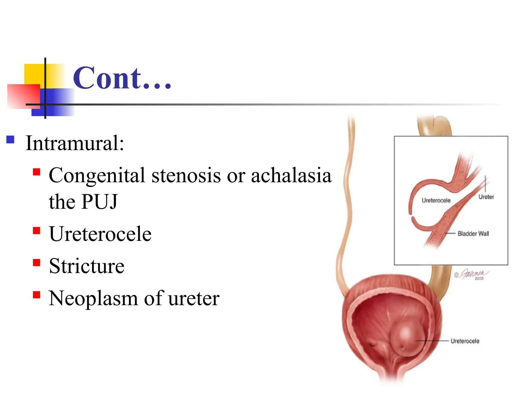 lec urethral strictures & hydronephrosis | PPT