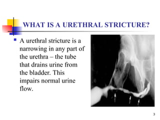 lec urethral strictures & hydronephrosis | PPT