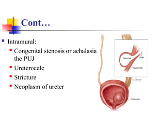 Lect 37 urethral-strictures and hydronephrosis.ppt