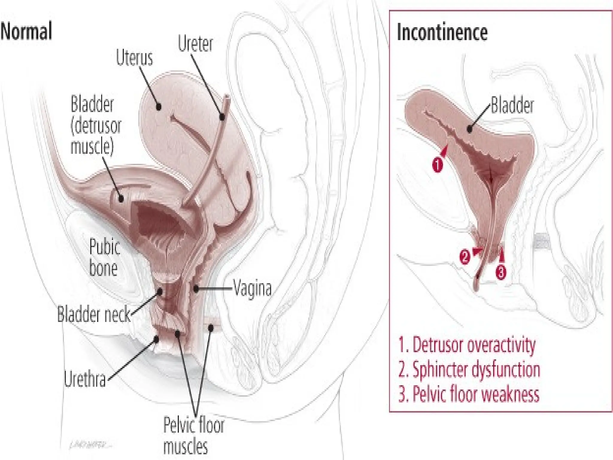 Lect 38. Urinary incontinenece , retension and calcili.pptx