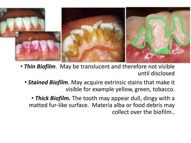 LECT 3 DENTAL PLAQUE DEFINITION AND AETIOLOGY .pptx
