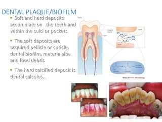 LECT 3 DENTAL PLAQUE DEFINITION AND AETIOLOGY .pptx