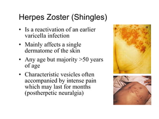 Lect 4 - Varicella-zoster virus (vzv), cmv, ebv | PPT