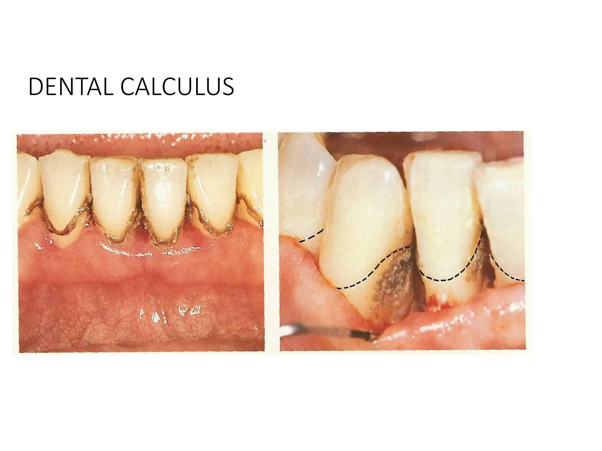 LECT 4 DENTAL CALCULUS INCLUDING FORMATION AND CAUSES.pptx