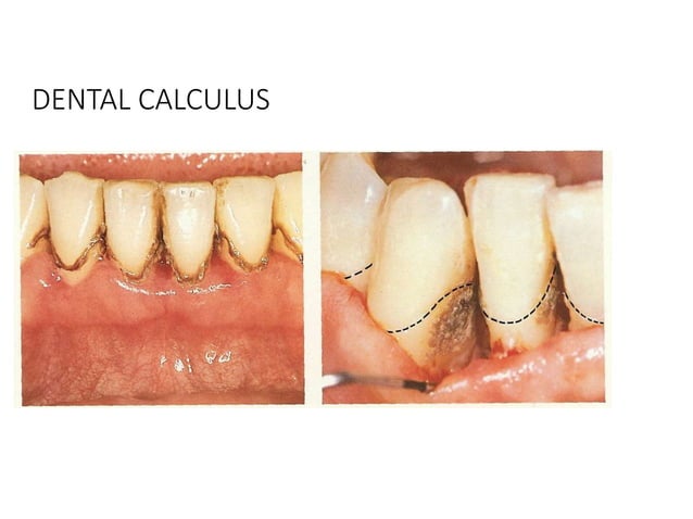 LECT 4 DENTAL CALCULUS INCLUDING FORMATION AND CAUSES.pptx