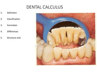 LECT 4 DENTAL CALCULUS INCLUDING FORMATION AND CAUSES.pptx