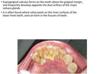 LECT 4 DENTAL CALCULUS INCLUDING FORMATION AND CAUSES.pptx