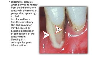 LECT 4 DENTAL CALCULUS INCLUDING FORMATION AND CAUSES.pptx