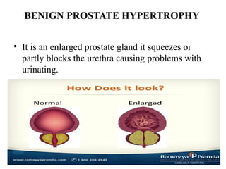 Lect 60. Benign prostrate Hyperplasia.pptx