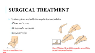 lect_7_-_Internal_fixation_-_I.pptx