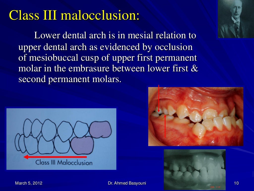 Etiology of Malocclusion I