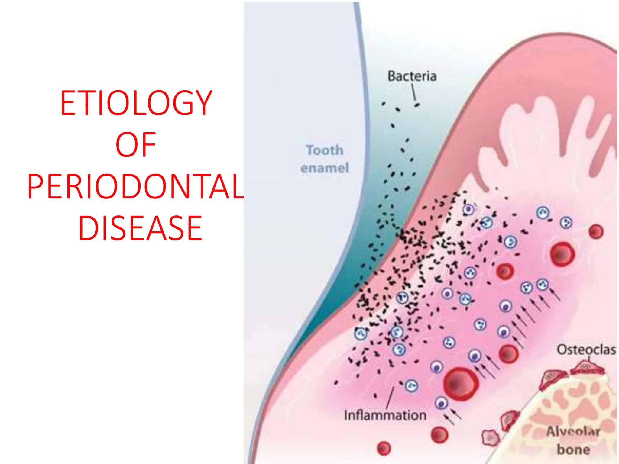 LECT 7 ETIOLOGY OF PERIODONTAL DISEASE .pptx