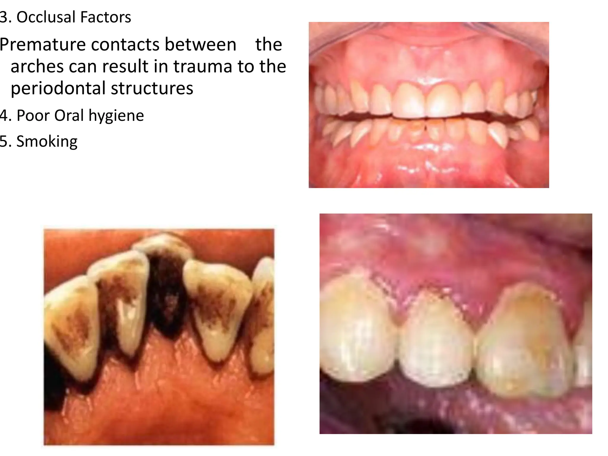 LECT 7 ETIOLOGY OF PERIODONTAL DISEASE .pptx