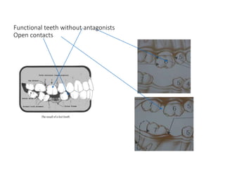 LECT 7 ETIOLOGY OF PERIODONTAL DISEASE .pptx