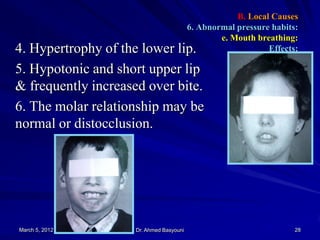 Etiology of Malocclusion II | PDF