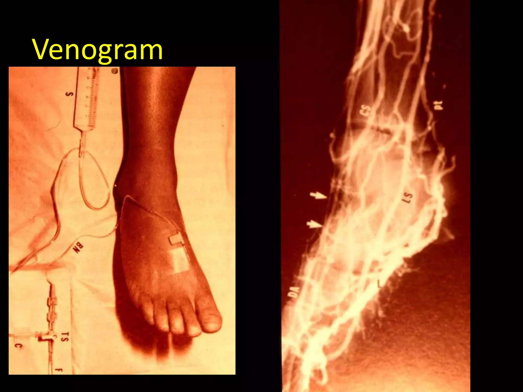 Lect 9 VTE- DVT-PE .pptx