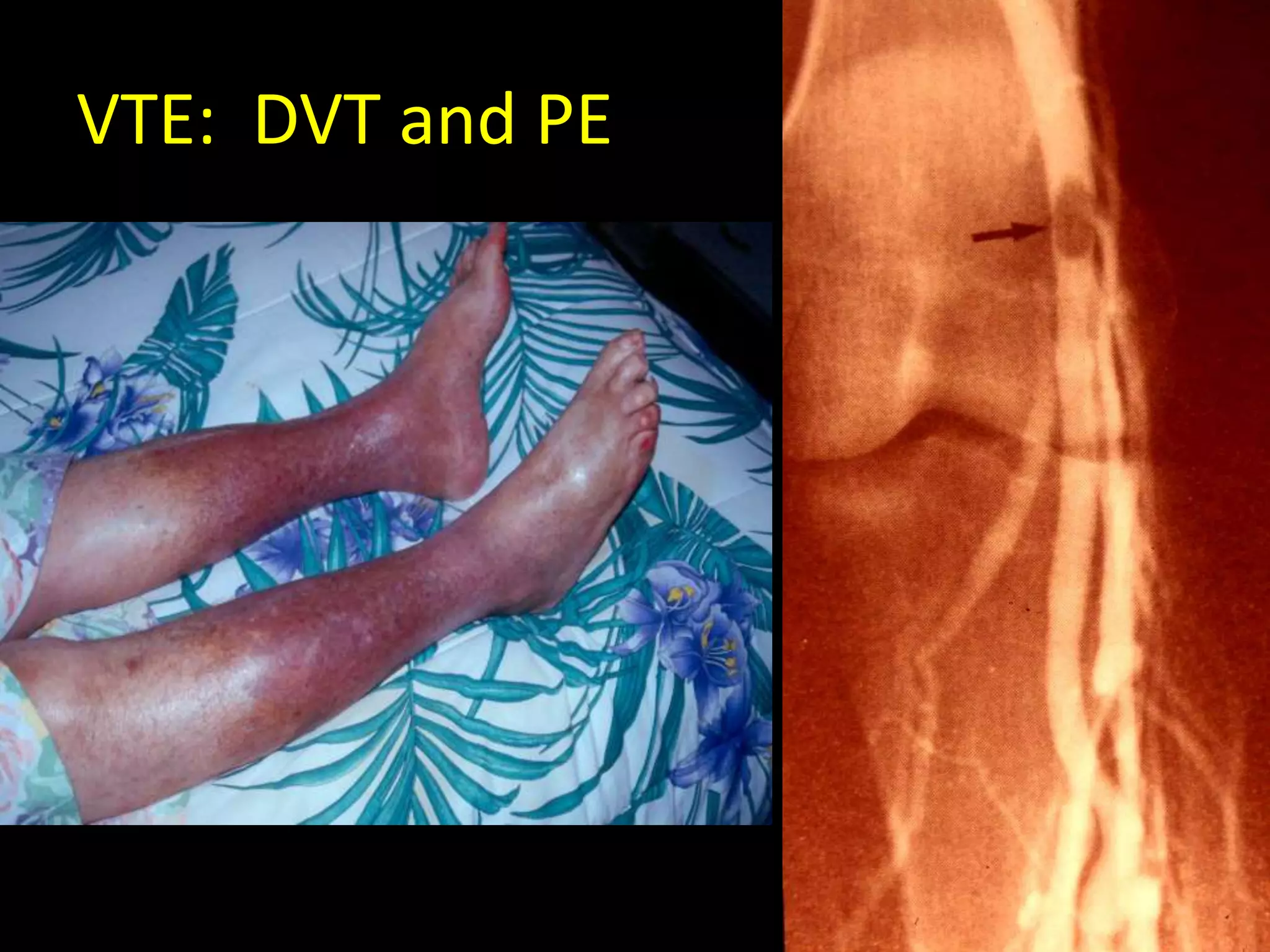 Lect 9 VTE- DVT-PE .pptx
