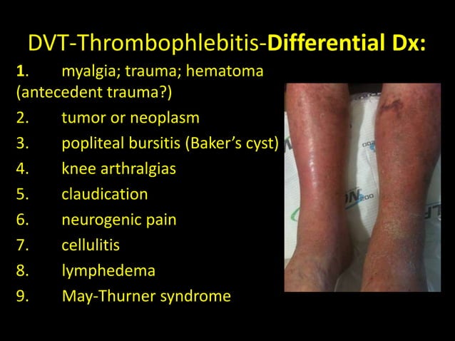 Lect 9 VTE- DVT-PE .pptx