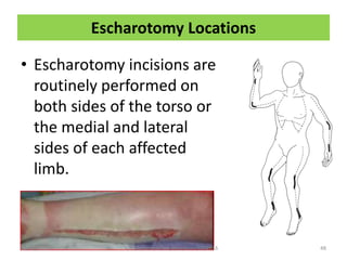 Physical Dysfunction: Burn Rehabilitation | PPT