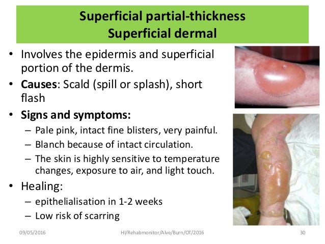 Physical Dysfunction: Burn Rehabilitation