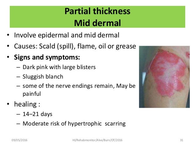 Physical Dysfunction: Burn Rehabilitation