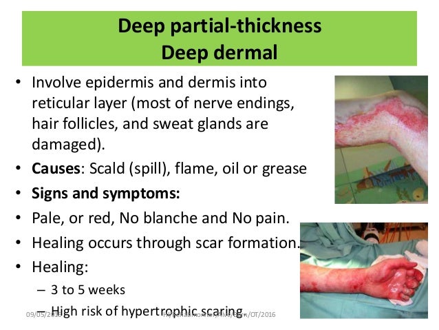 Physical Dysfunction: Burn Rehabilitation