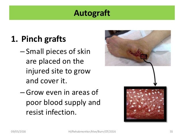 Physical Dysfunction: Burn Rehabilitation