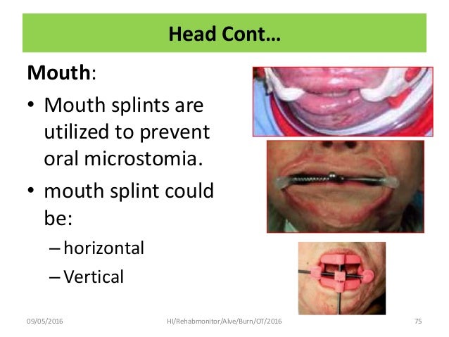 Physical Dysfunction: Burn Rehabilitation