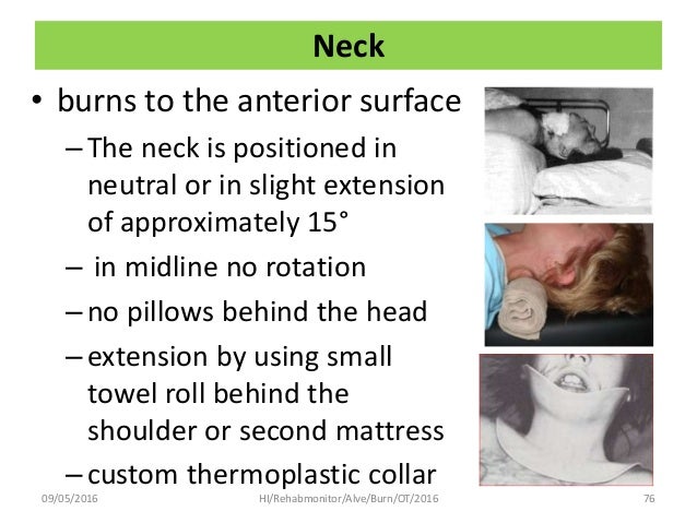 Physical Dysfunction: Burn Rehabilitation