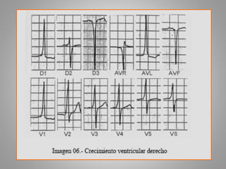 Lectura basica de ekg. | PPTX