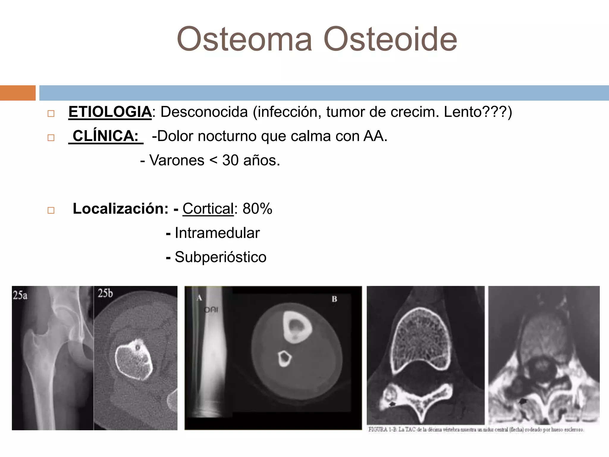 Osteoma osteoide | PPTX