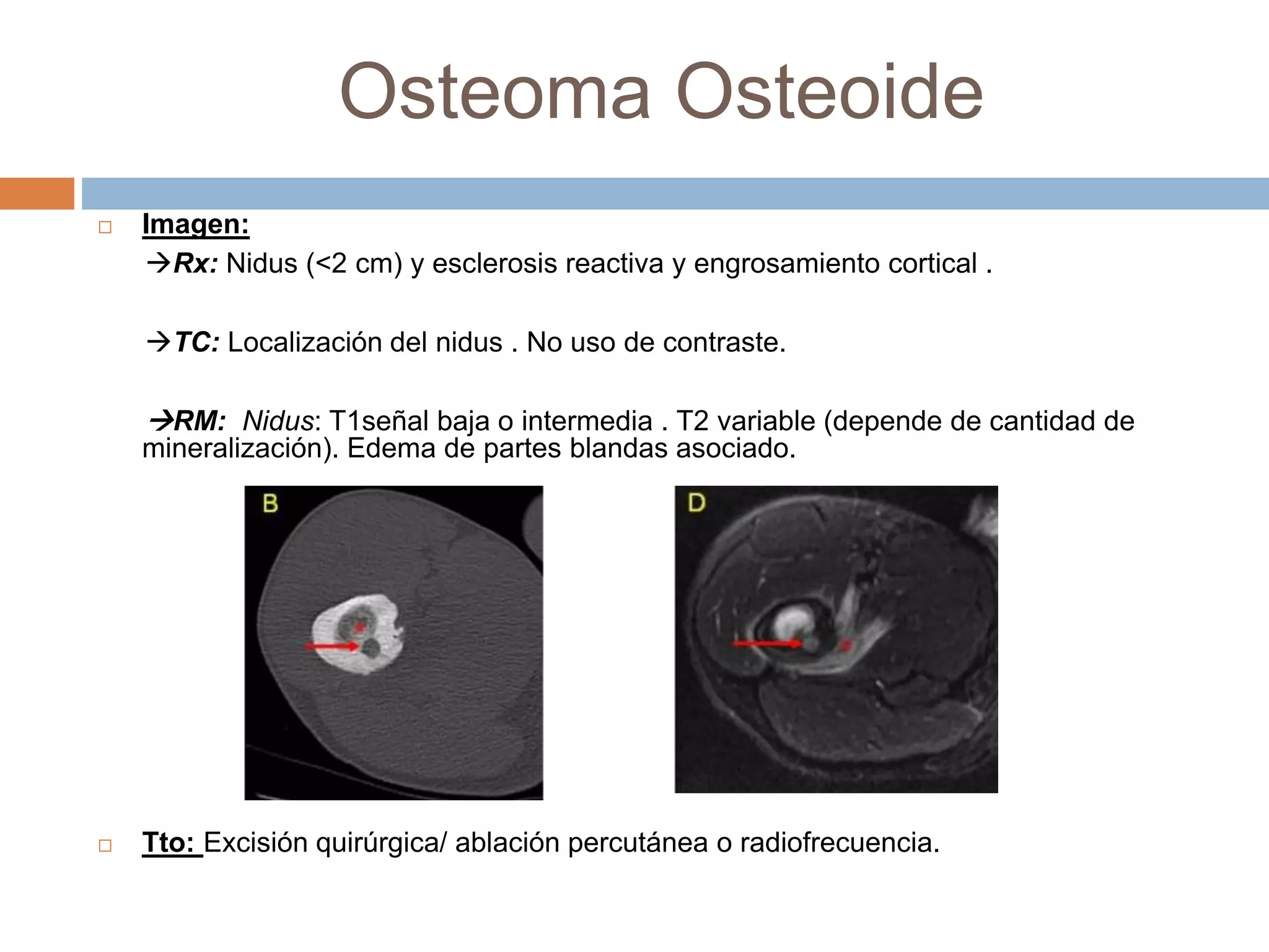 Osteoma osteoide | PPTX