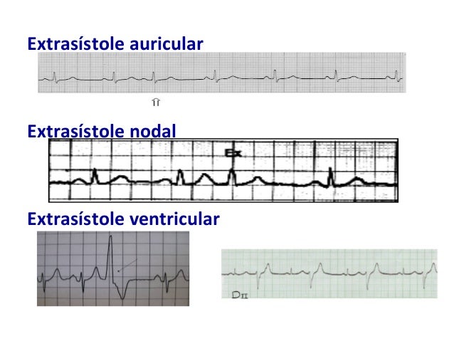 Lectura de ECG