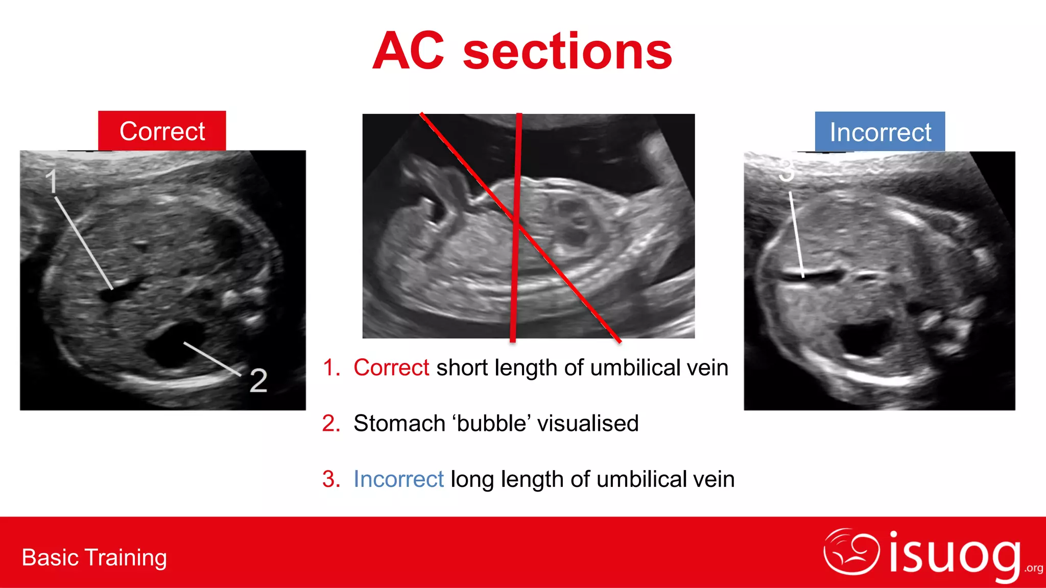 Lecture-10-Fetal-Biometry-Dating-Assessing-Size-Estimating-Fetal-Weig…