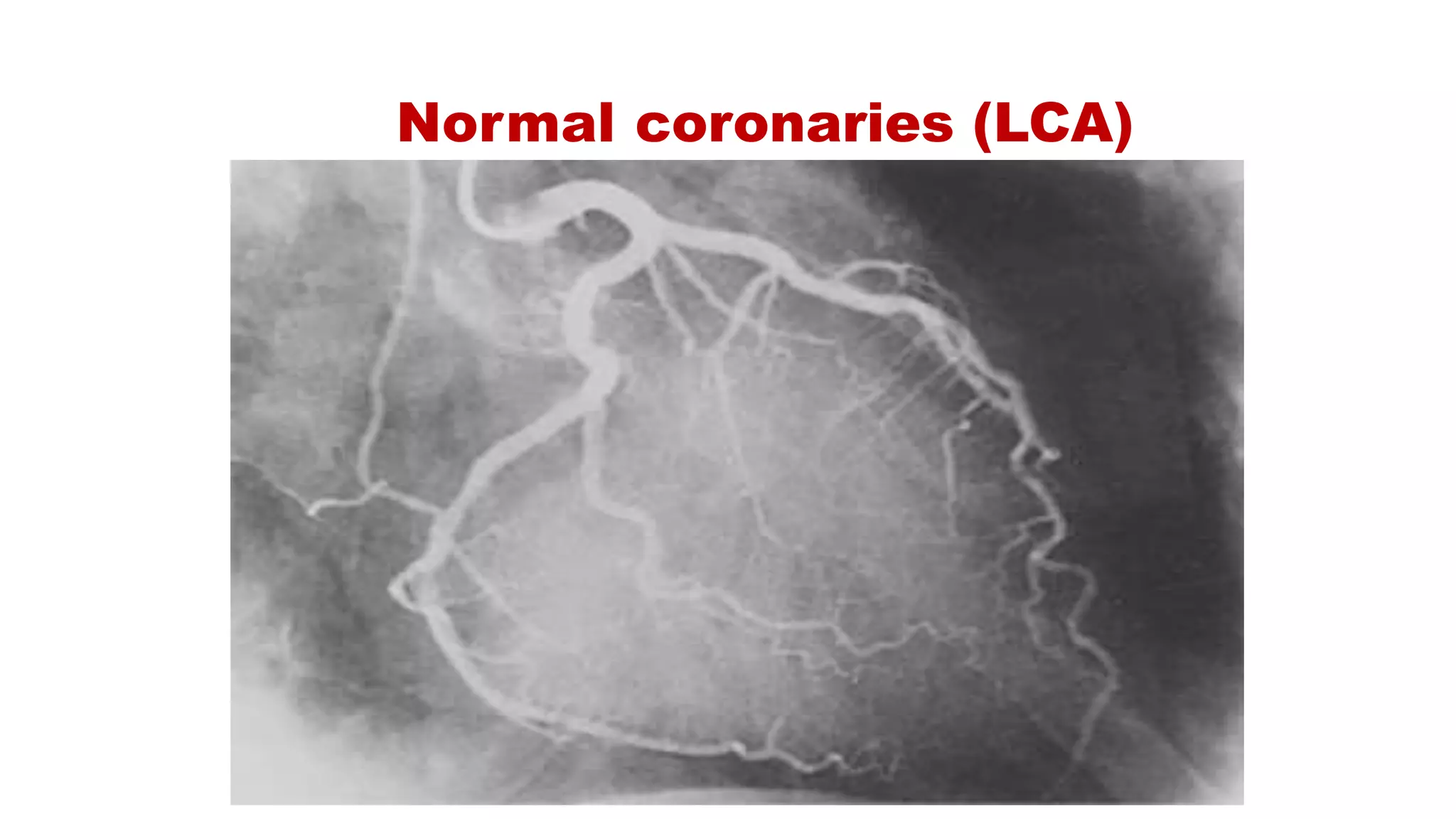 coronary angiography, LV angiogram and coronary anomalies | PPTX
