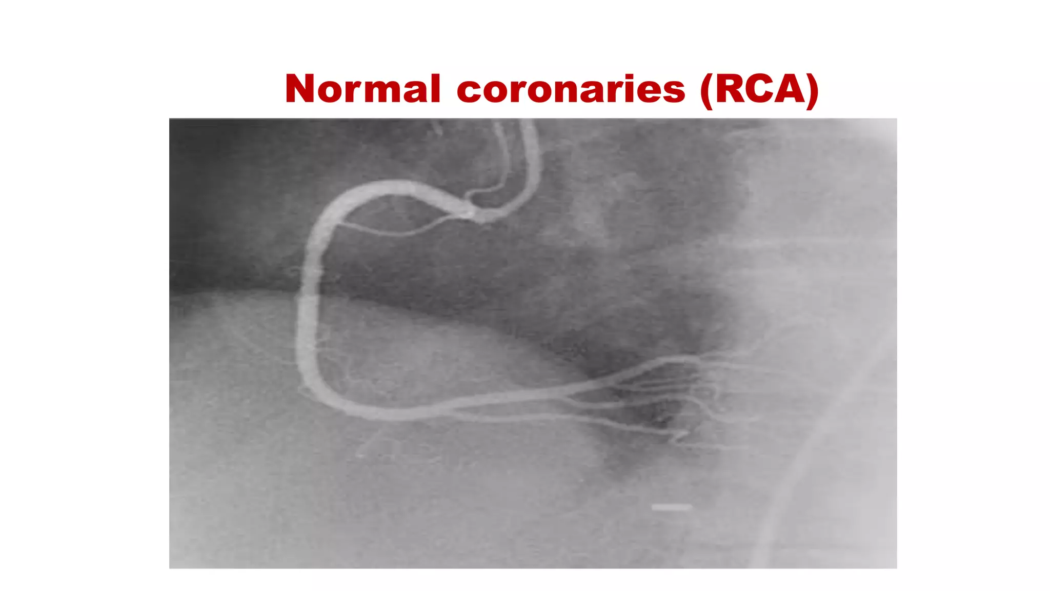 coronary angiography, LV angiogram and coronary anomalies | PPTX