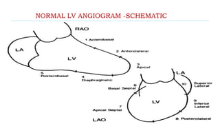 coronary angiography, LV angiogram and coronary anomalies | PPTX