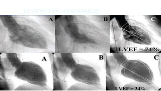 coronary angiography, LV angiogram and coronary anomalies | PPTX
