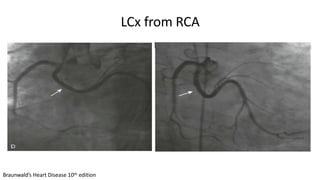 coronary angiography, LV angiogram and coronary anomalies | PPTX