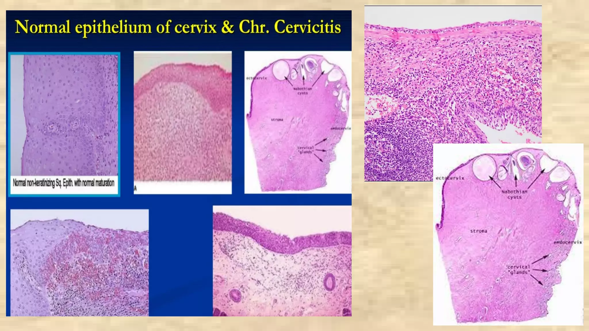 Lecture 1 Pathology: Cervix pdf | PDF