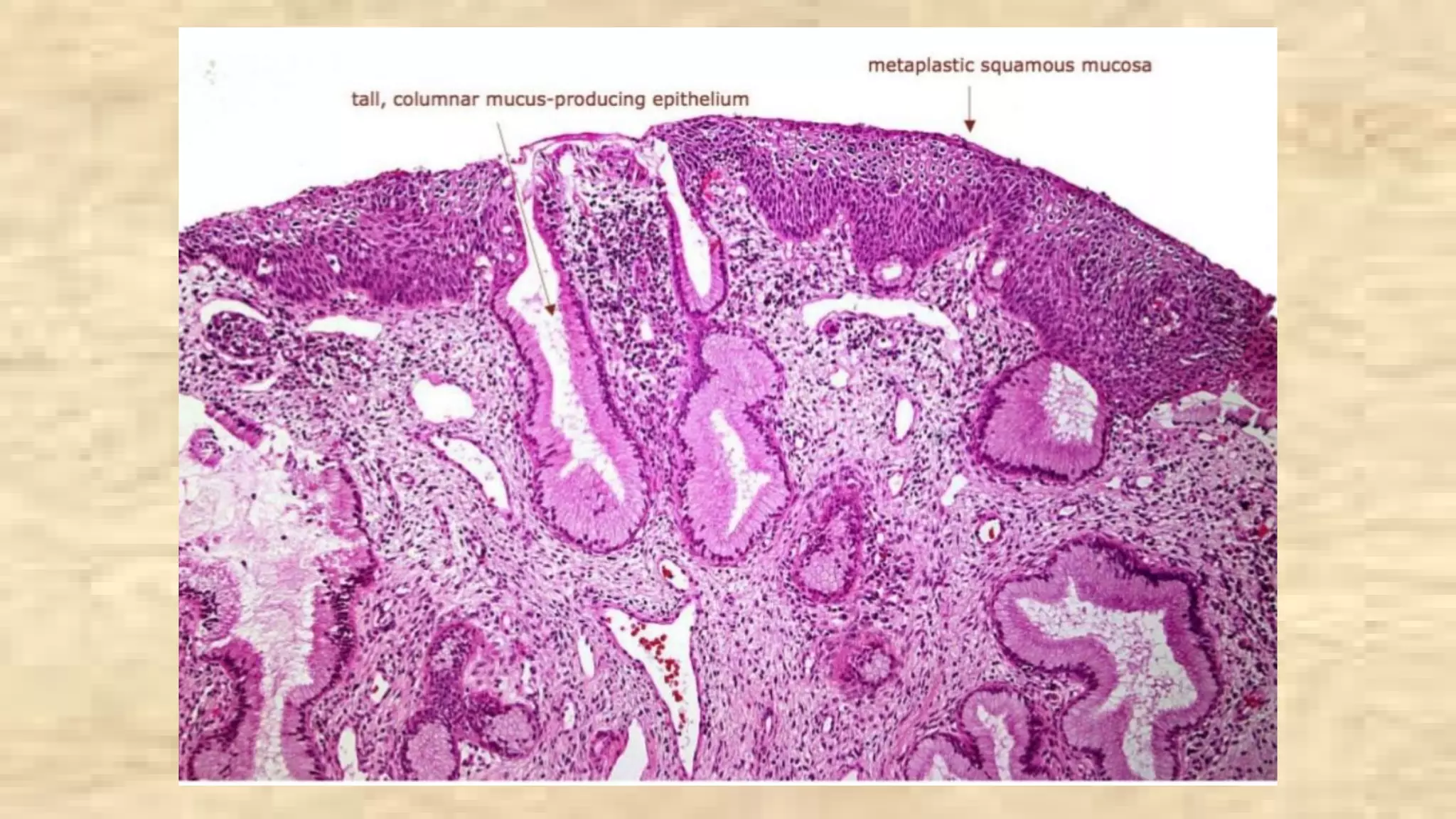 Lecture 1 Pathology Cervix Pdf Pdf